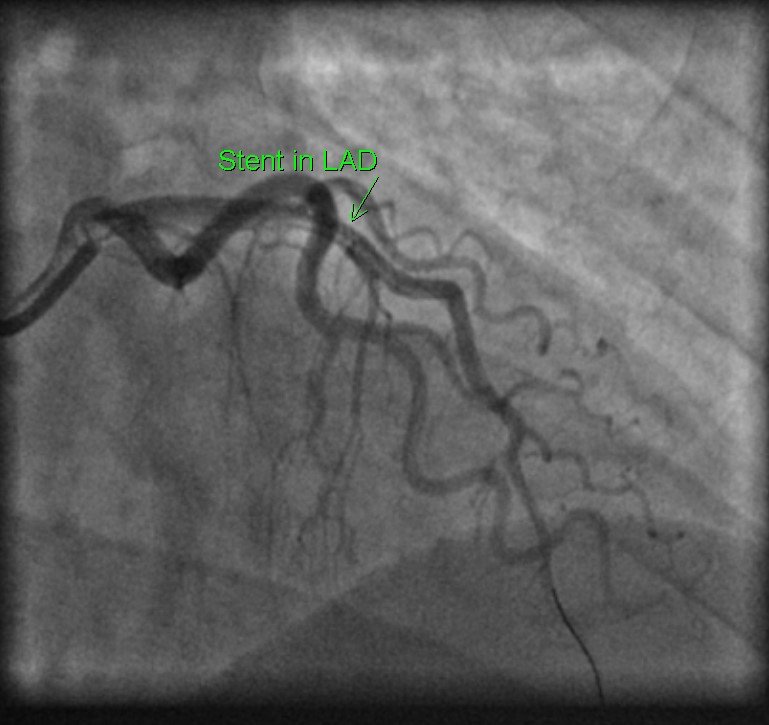 A 40-something woman with chest pain. A medic takes control of the ...