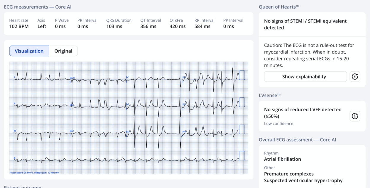 Atrial fibrillation with RVR and ST depression: POCUS, cardioversion ...