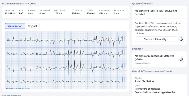 Atrial fibrillation with RVR and ST depression: POCUS, cardioversion ...