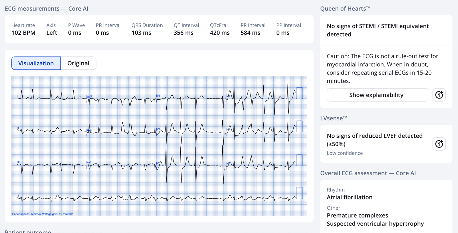 Atrial fibrillation with RVR and ST depression: POCUS, cardioversion ...