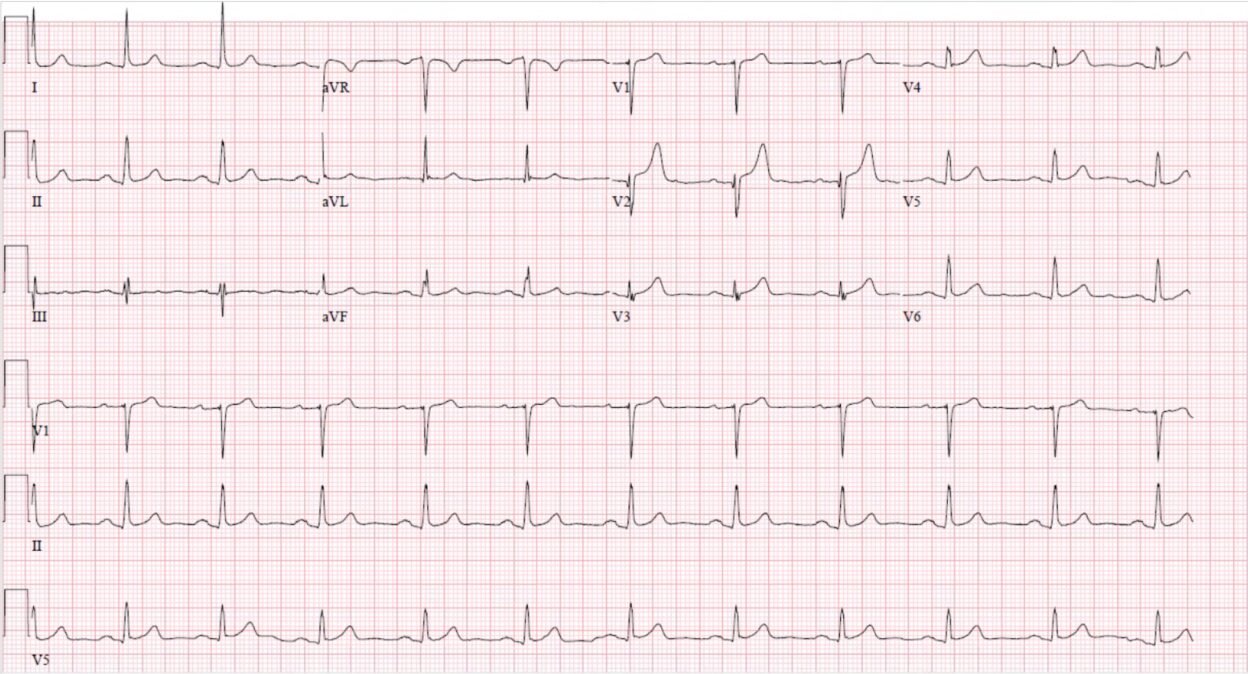 Watch what happens when "pericarditis" and morphine cloud your judgment ...