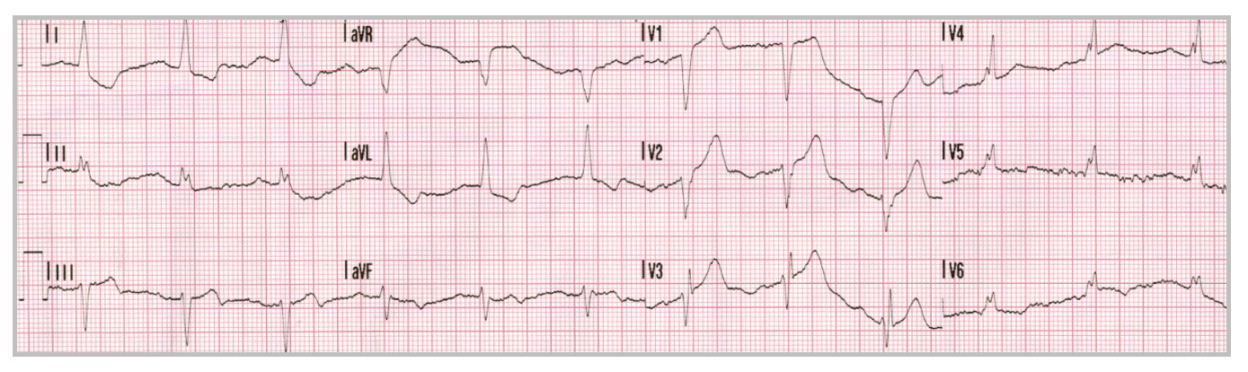 An 80-year-old with chest pain and a wide QRS. Should you give ...