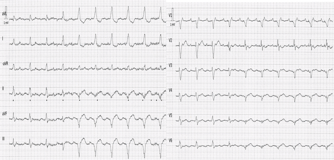 An 87-year-old with dyspnea and intermittent WCT - Dr. Smith’s ECG Blog