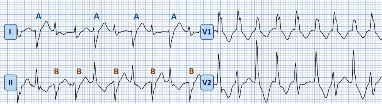 Recurrent Seizure. Or was it syncope? Diagnosis made after 20 years ...