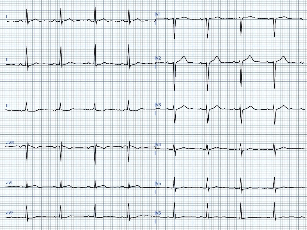 A 35-year old woman with this post-ROSC ECG. What does "shark fin ...