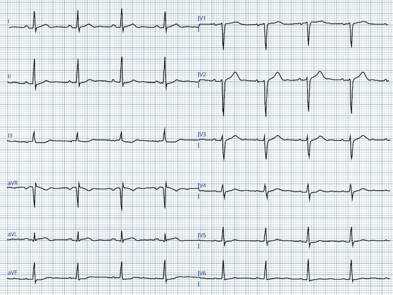 A 35-year old woman with this post-ROSC ECG. What does "shark fin ...