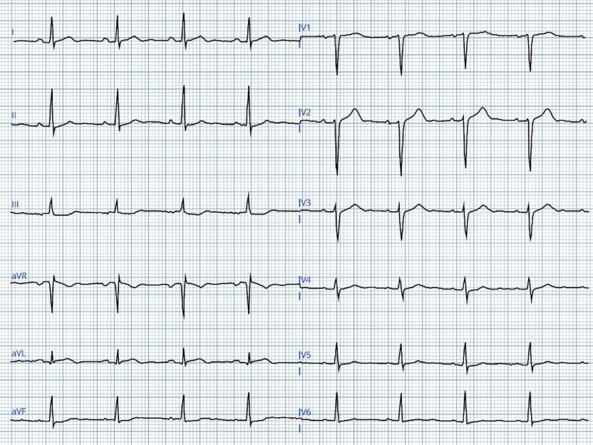 A 35-year old woman with this post-ROSC ECG. What does "shark fin ...