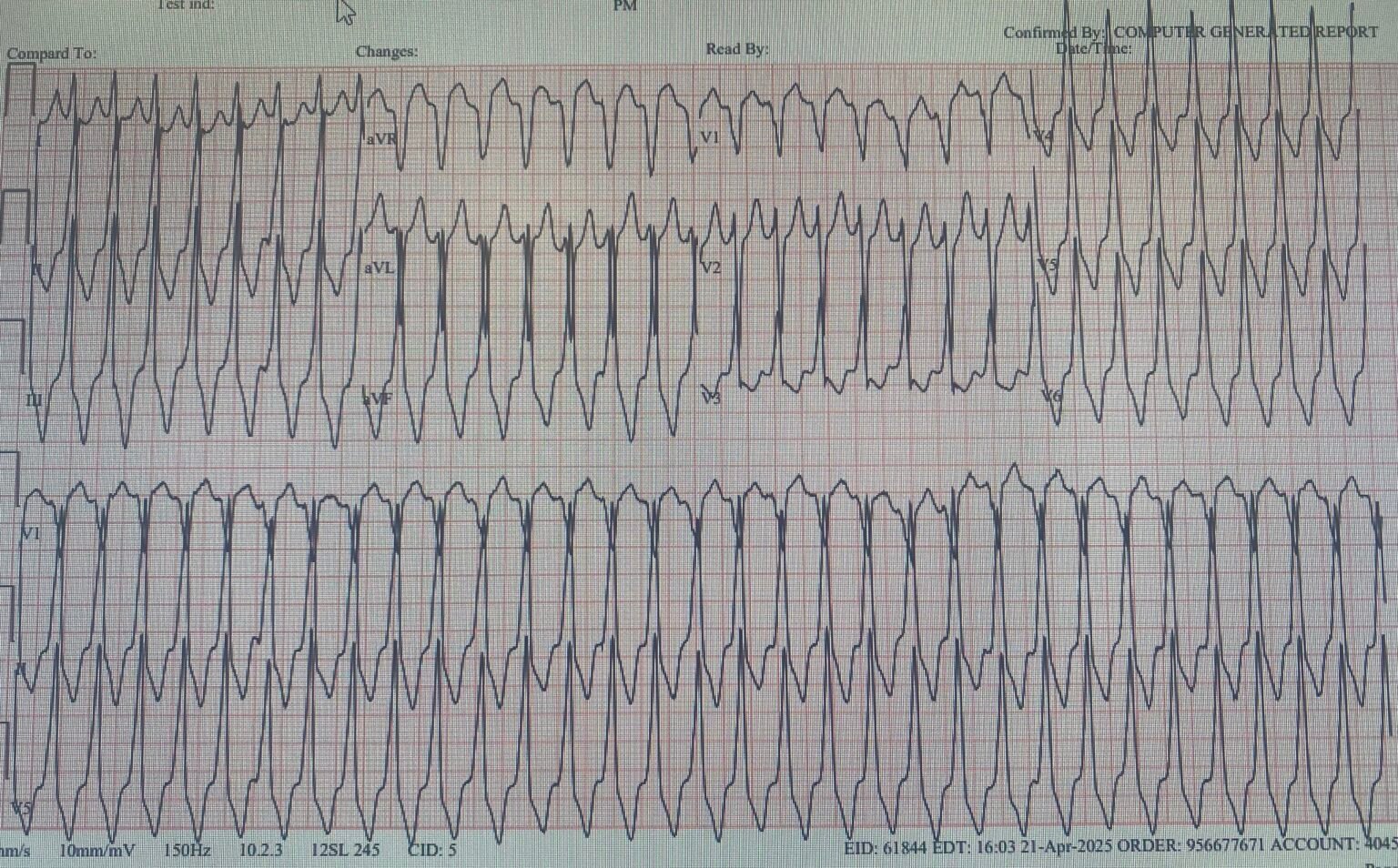 Wide Complex Tachycardia, intermittent - Dr. Smith’s ECG Blog