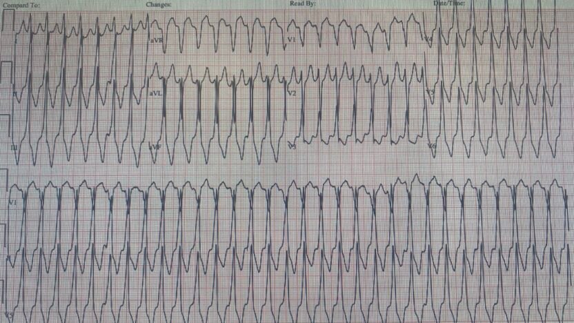 Steve Smith, Author at Dr. Smith’s ECG Blog