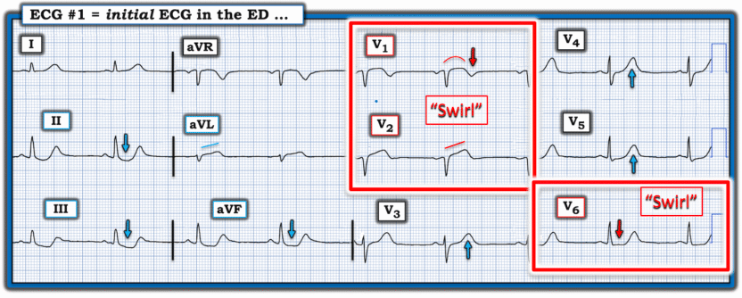 What is this Pattern? Is an initial troponin I of 45 ng/L diagnostic ...