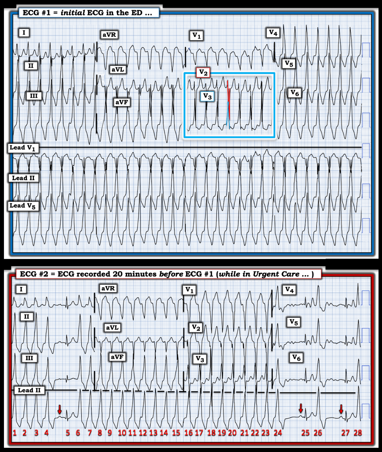Wide Complex Tachycardia, intermittent - Dr. Smith’s ECG Blog