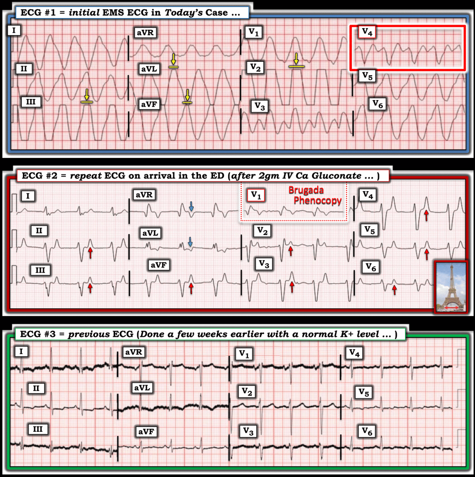Chest pain and nausea with a diagnostic ECG - Dr. Smith’s ECG Blog