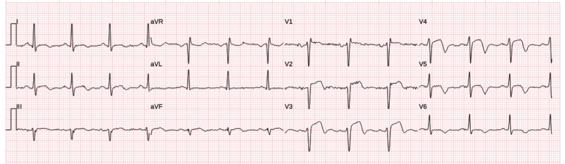 Back to basics: ECGs are dynamic, get serial ECGs and learn the OMI ...