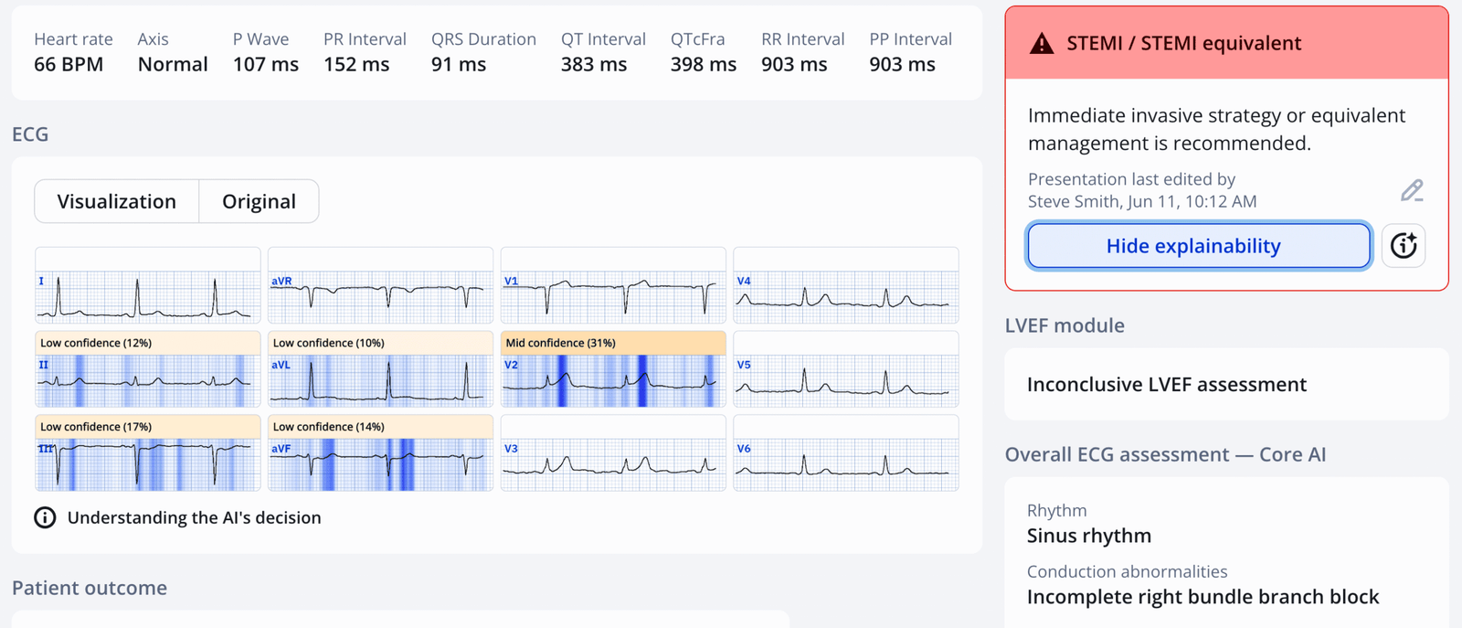 This is Excellent OMI Care - Dr. Smith’s ECG Blog