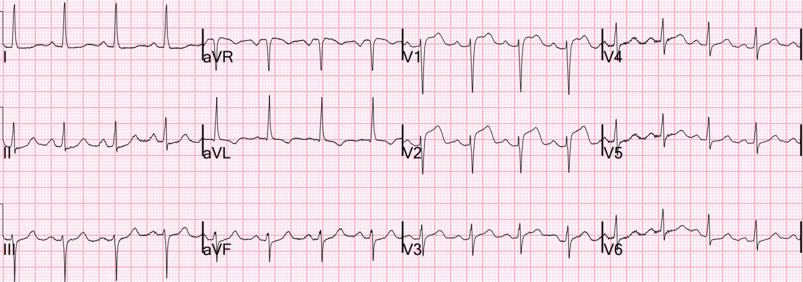 Even OMI that are STEMI are missed, and called "Not a STEMI" - Dr ...