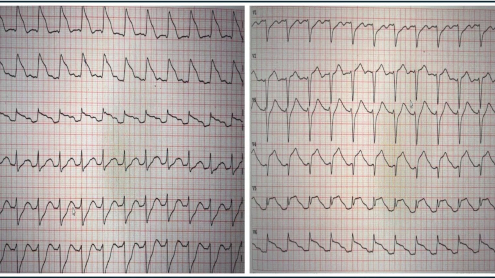 A 35-year old woman with this post-ROSC ECG. What does "shark fin ...