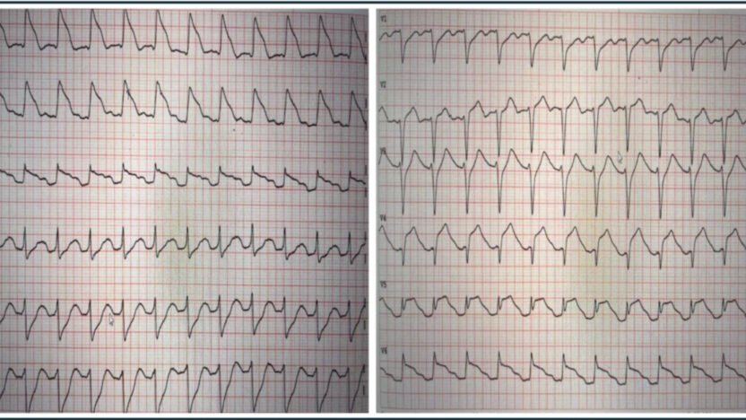 A 35-year old woman with this post-ROSC ECG. What does "shark fin ...