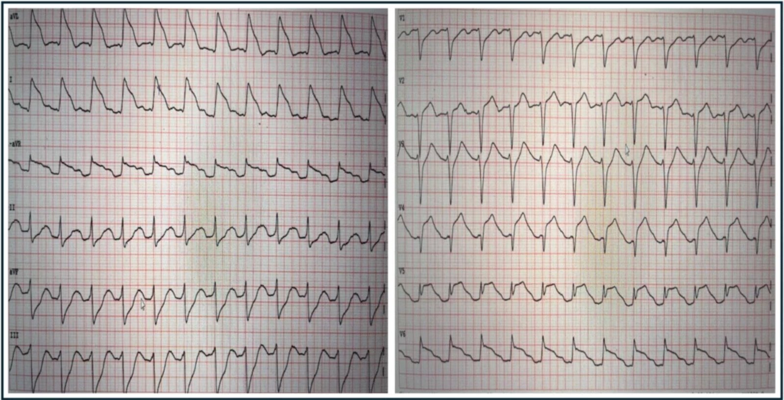A 35-year old woman with this post-ROSC ECG. What does "shark fin ...