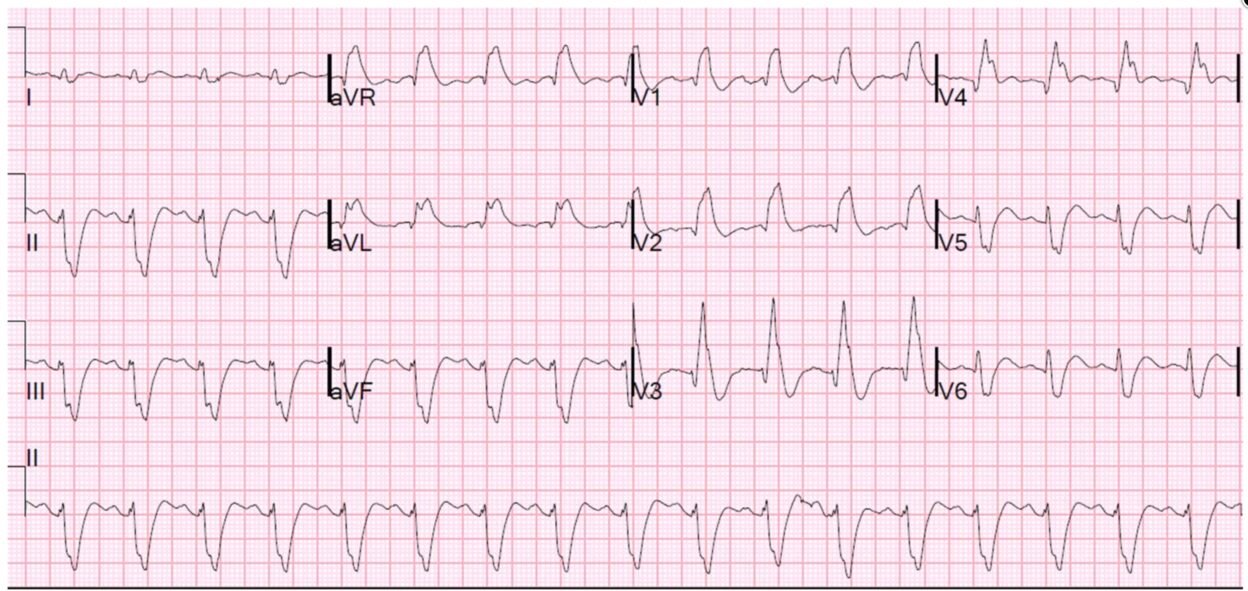 70-something with acute chest pain, Right Bundle Branch block, ST ...