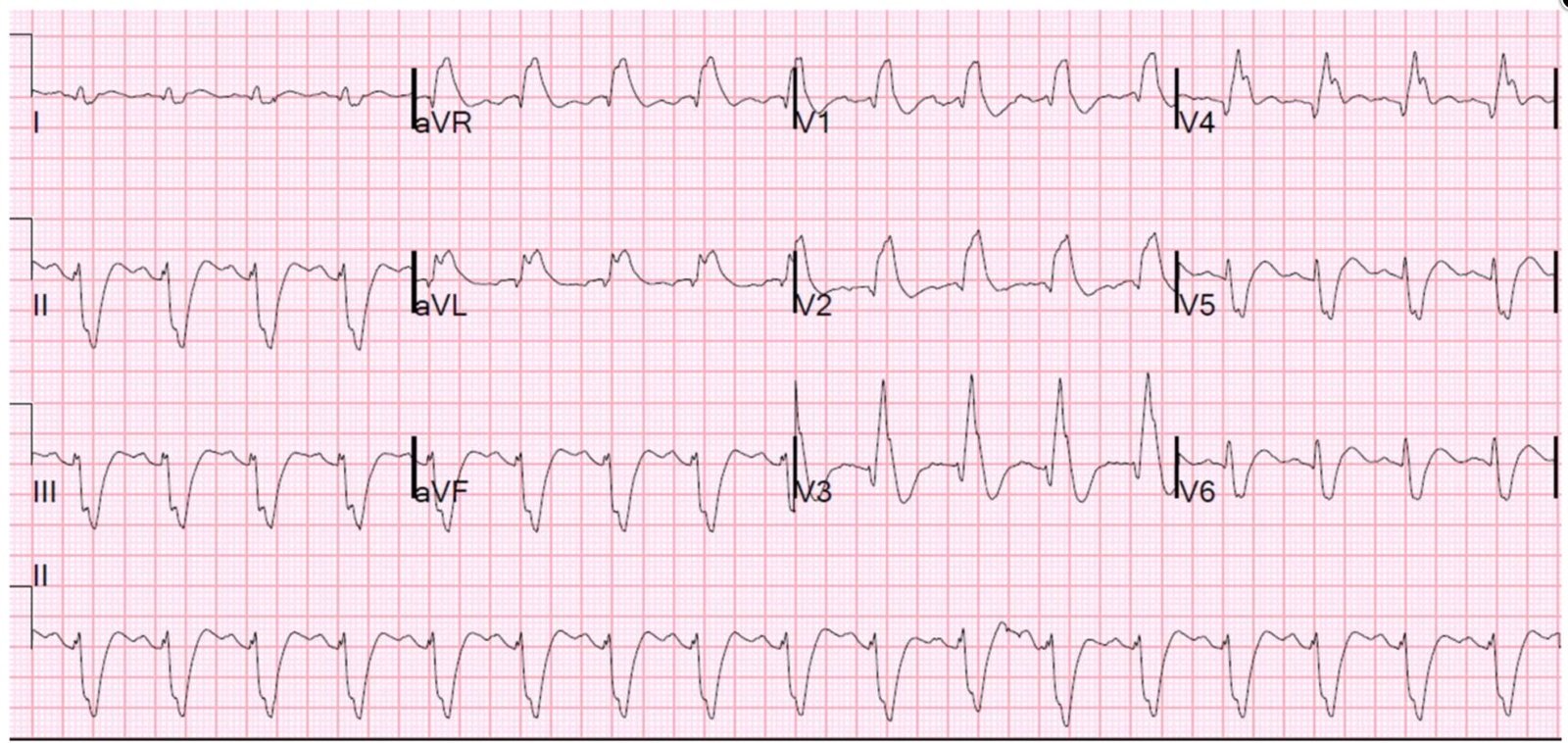 70-something with acute chest pain, Right Bundle Branch block, ST ...