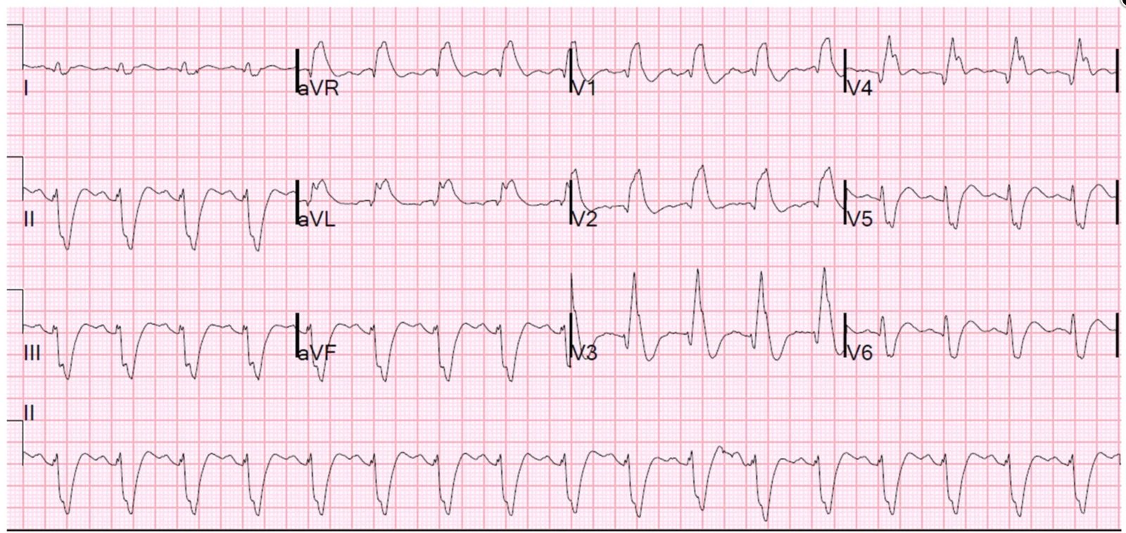 70-something with acute chest pain, Right Bundle Branch block, ST ...
