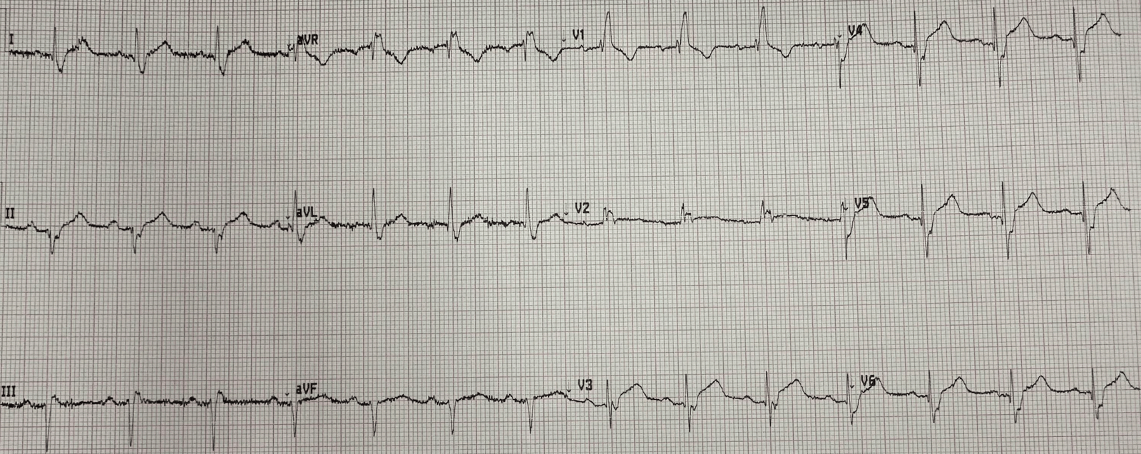 70-something with acute chest pain, Right Bundle Branch block, ST ...