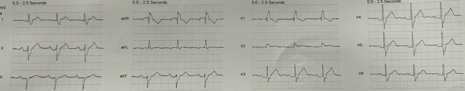 70-something with acute chest pain, Right Bundle Branch block, ST ...