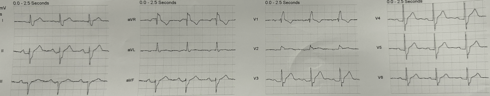 70-something with acute chest pain, Right Bundle Branch block, ST ...