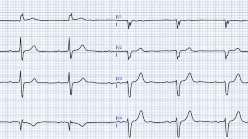 70-something with acute chest pain, Right Bundle Branch block, ST ...