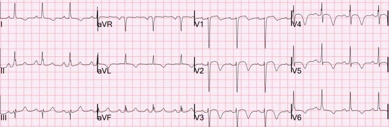 Even OMI that are STEMI are missed, and called "Not a STEMI" - Dr ...