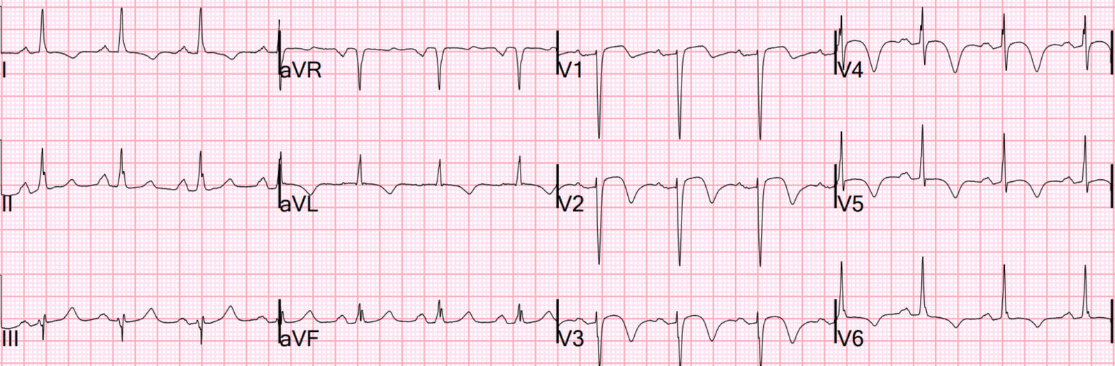 Even OMI that are STEMI are missed, and called "Not a STEMI" - Dr ...