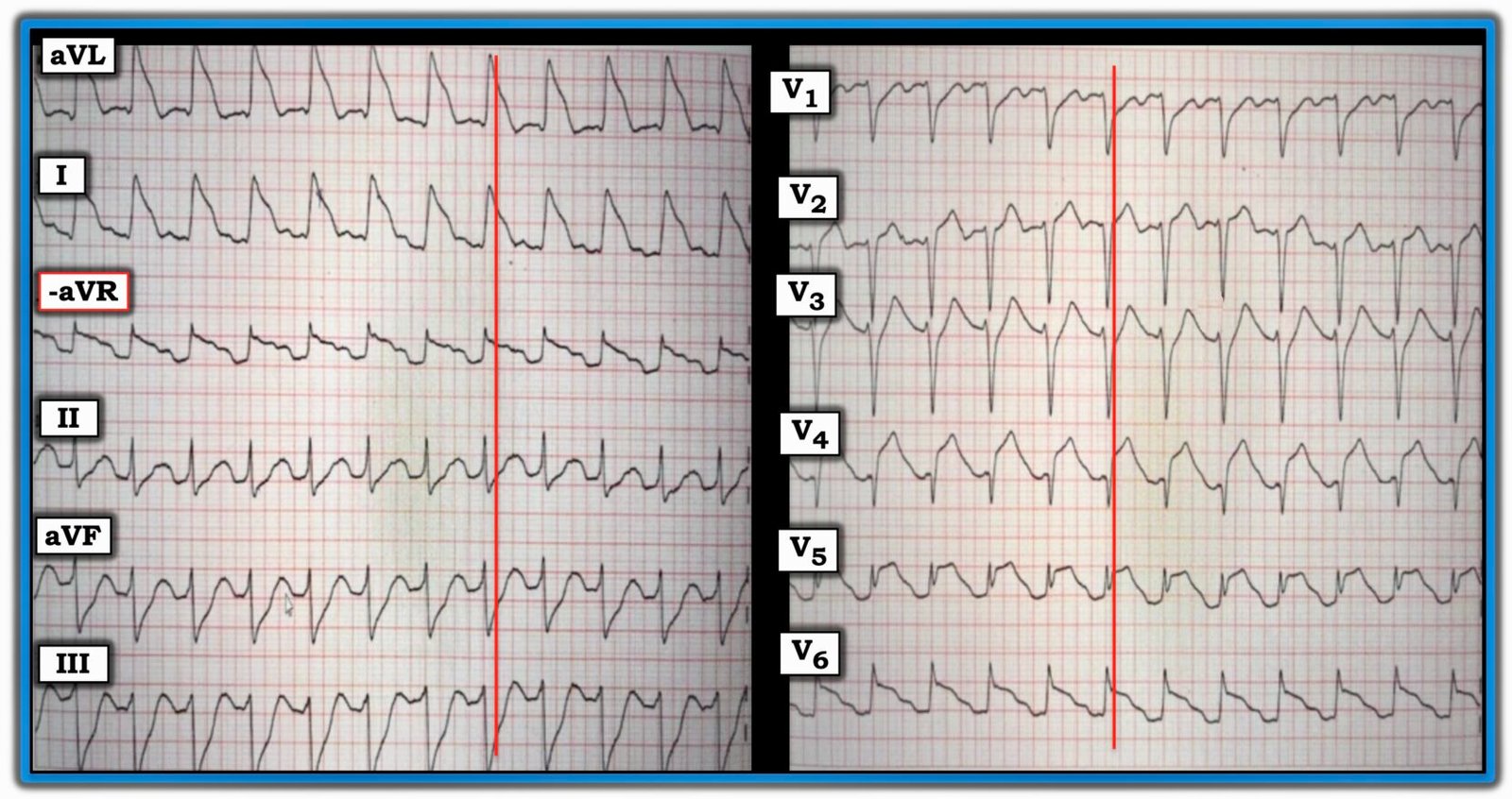 A 35-year old woman with this post-ROSC ECG. What does "shark fin ...