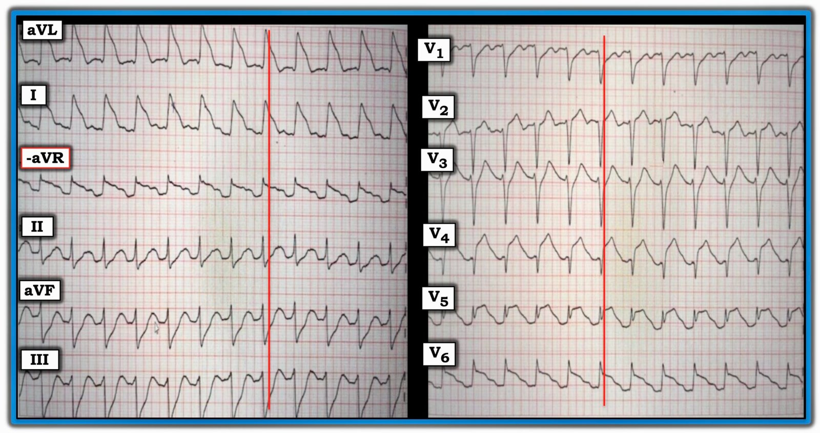 A 35-year old woman with this post-ROSC ECG. What does "shark fin ...