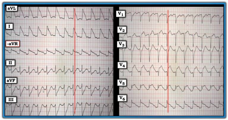 A 35-year old woman with this post-ROSC ECG. What does "shark fin ...