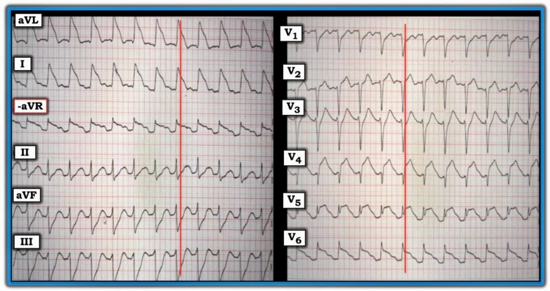 A 35-year old woman with this post-ROSC ECG. What does "shark fin ...