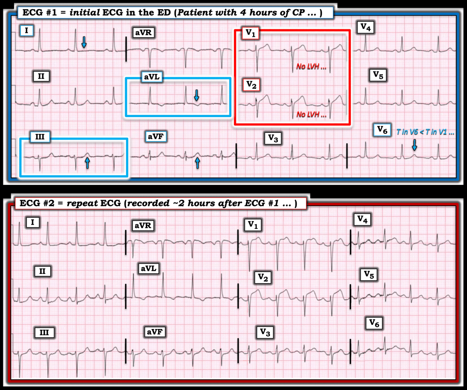 Even OMI that are STEMI are missed, and called "Not a STEMI" - Dr ...