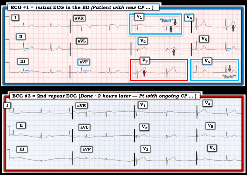 75 year old with acute chest pain: 6 bad reasons not to cath. - Dr ...