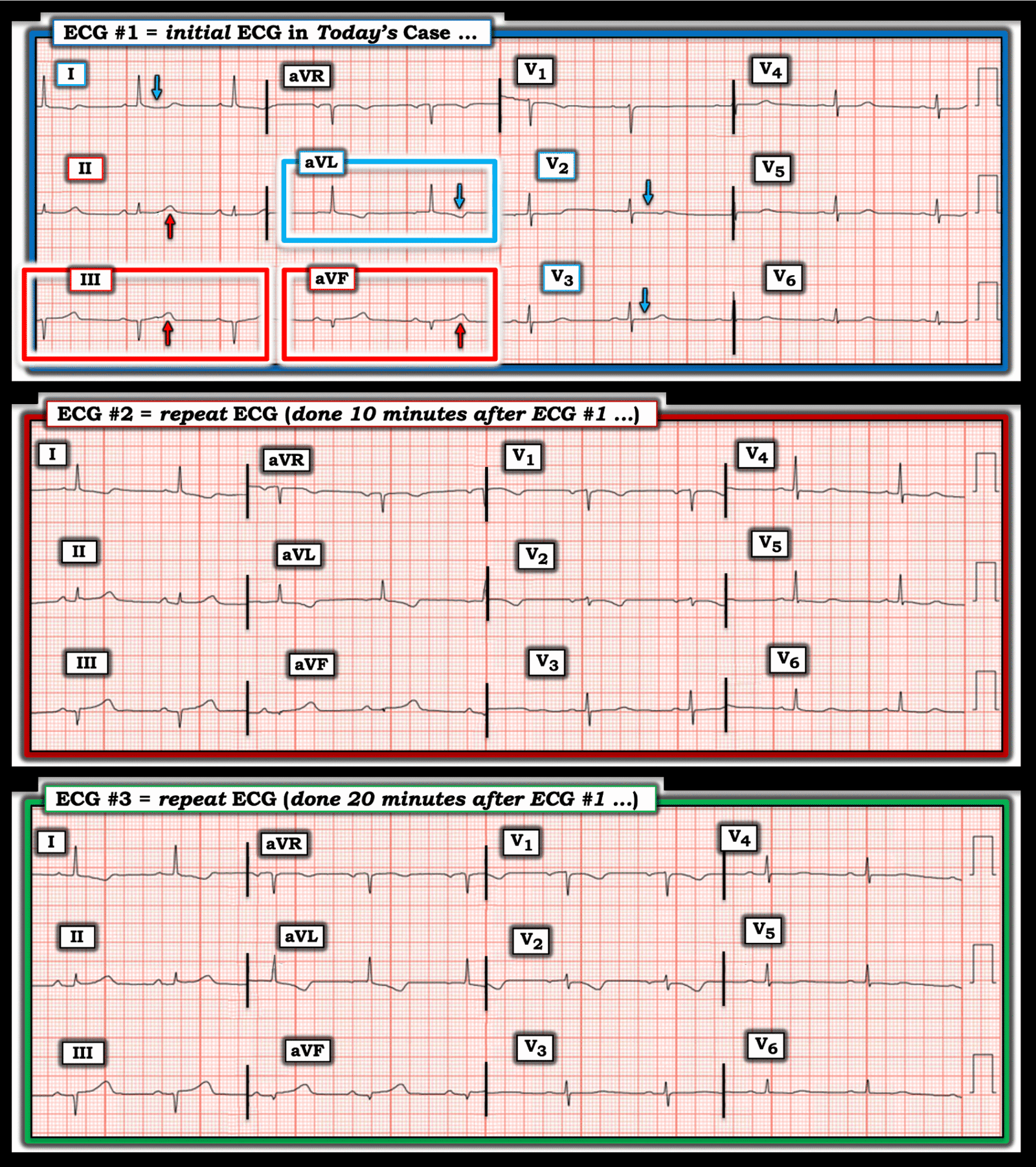 Is it Always Best to Activate when Convinced of Acute OMI in a STEMI ...