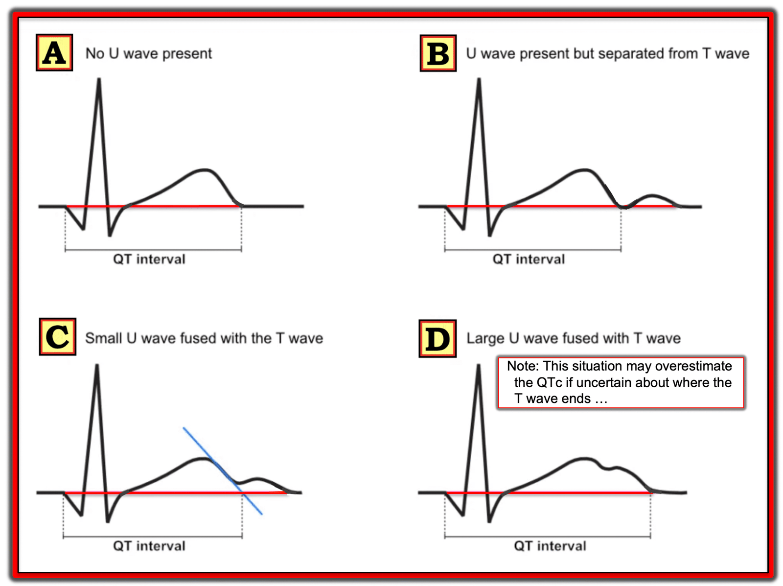 Online QTc Calculator for normal and wide QRS (LBBB, RBBB, etc.) - Dr ...