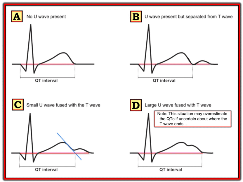 Online QTc Calculator for normal and wide QRS (LBBB, RBBB, etc.) - Dr ...