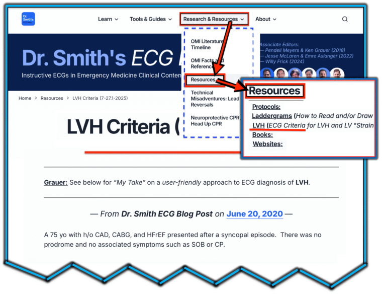 LVH Criteria (7-27.1-2025) - Dr. Smith’s ECG Blog
