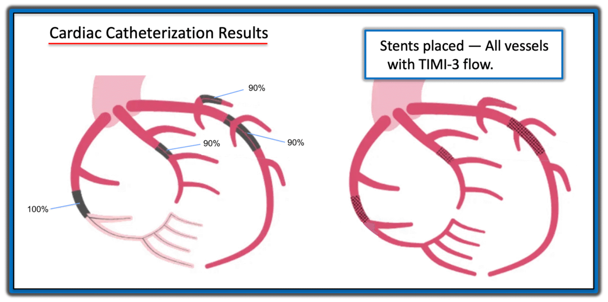 Is it Always Best to Activate when Convinced of Acute OMI in a STEMI ...