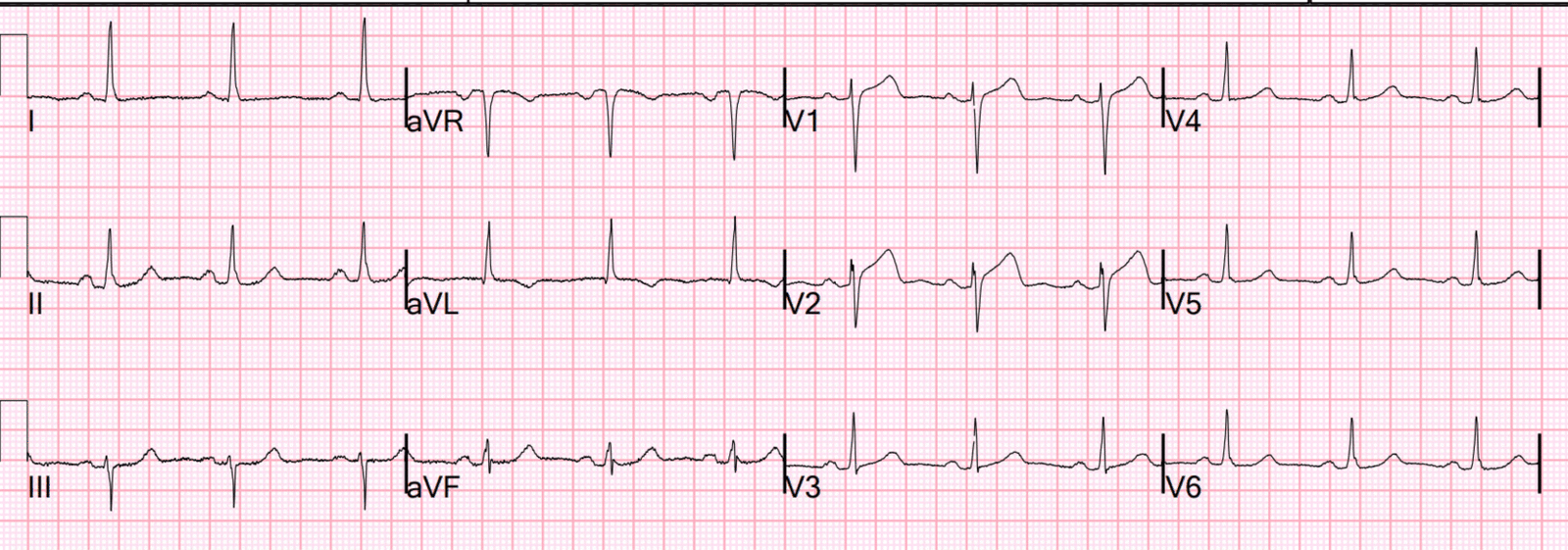 Even OMI that are STEMI are missed, and called "Not a STEMI" - Dr ...