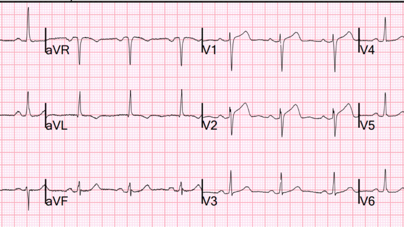 Dr. Smith’s ECG Blog - Page 2 of 194 - Expert ECG Interpretation and ...