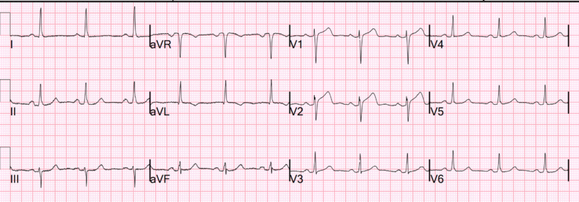 Even OMI that are STEMI are missed, and called "Not a STEMI" - Dr ...