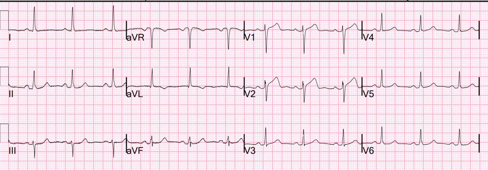 Even OMI that are STEMI are missed, and called "Not a STEMI" - Dr ...