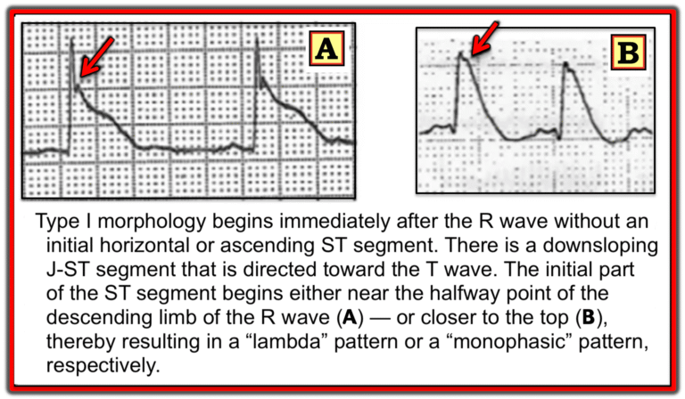 A 35-year old woman with this post-ROSC ECG. What does "shark fin ...