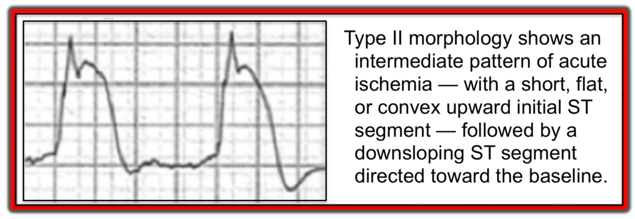 A 35-year old woman with this post-ROSC ECG. What does "shark fin ...