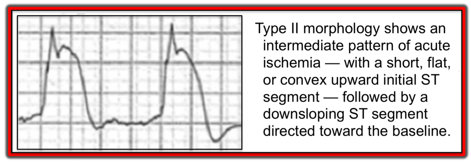 A 35-year old woman with this post-ROSC ECG. What does "shark fin ...