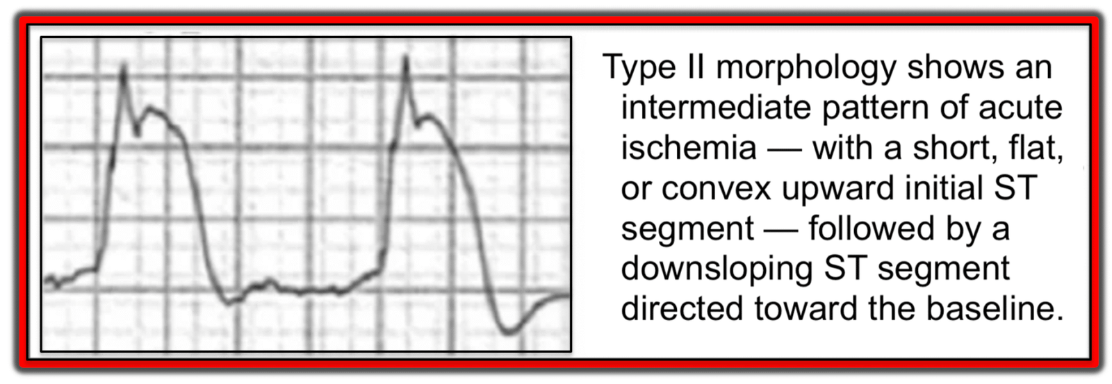 A 35-year old woman with this post-ROSC ECG. What does "shark fin ...